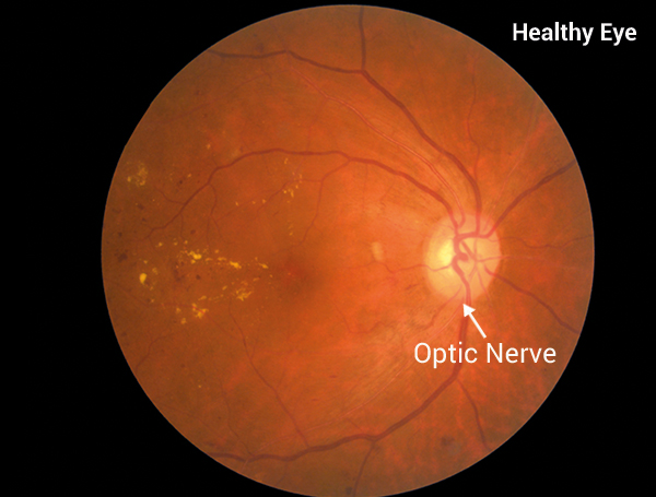 Fundus Photography Test in Billingham, Middlesbrough & Ingleby-Barwick